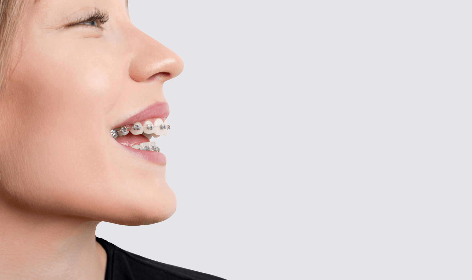 Fixed Braces | Orthodontic Treatments | Belwell Dental Birmingham