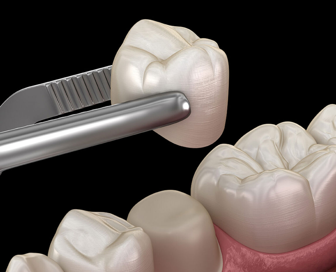 Crowns, Inlays & Onlays | Dental Restoration | Belwell Dental
