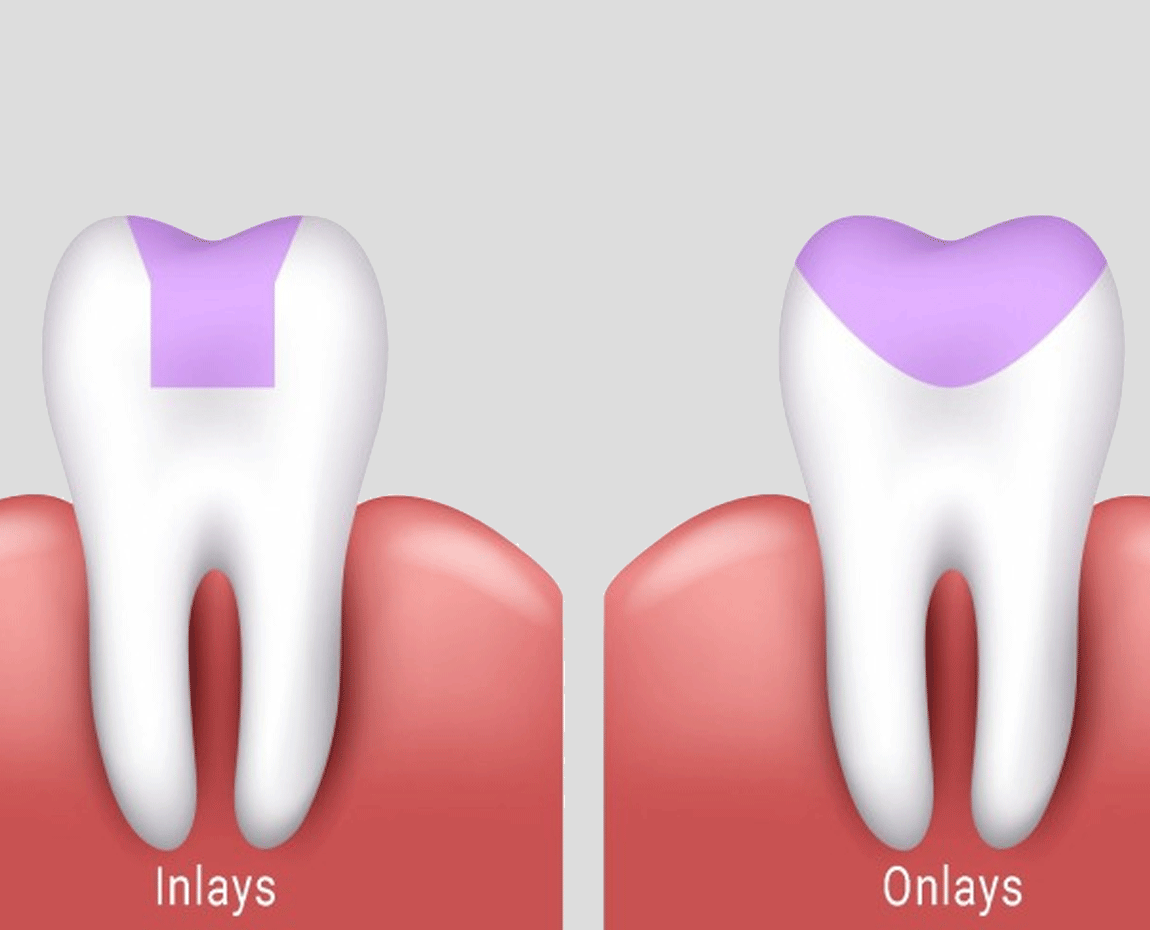 Crowns, Inlays & Onlays | Dental Restoration | Belwell Dental