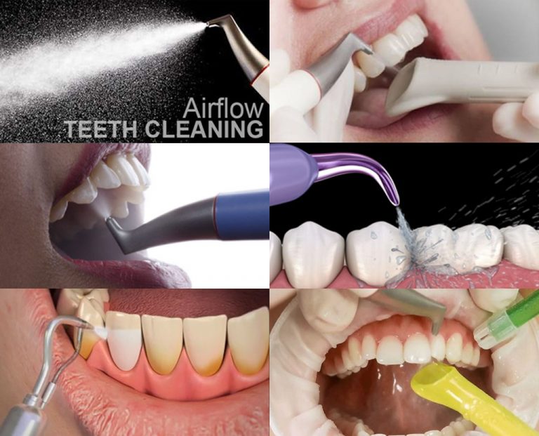 Dental Hygienist Birmingham | Airflow Treatment | Periodontist